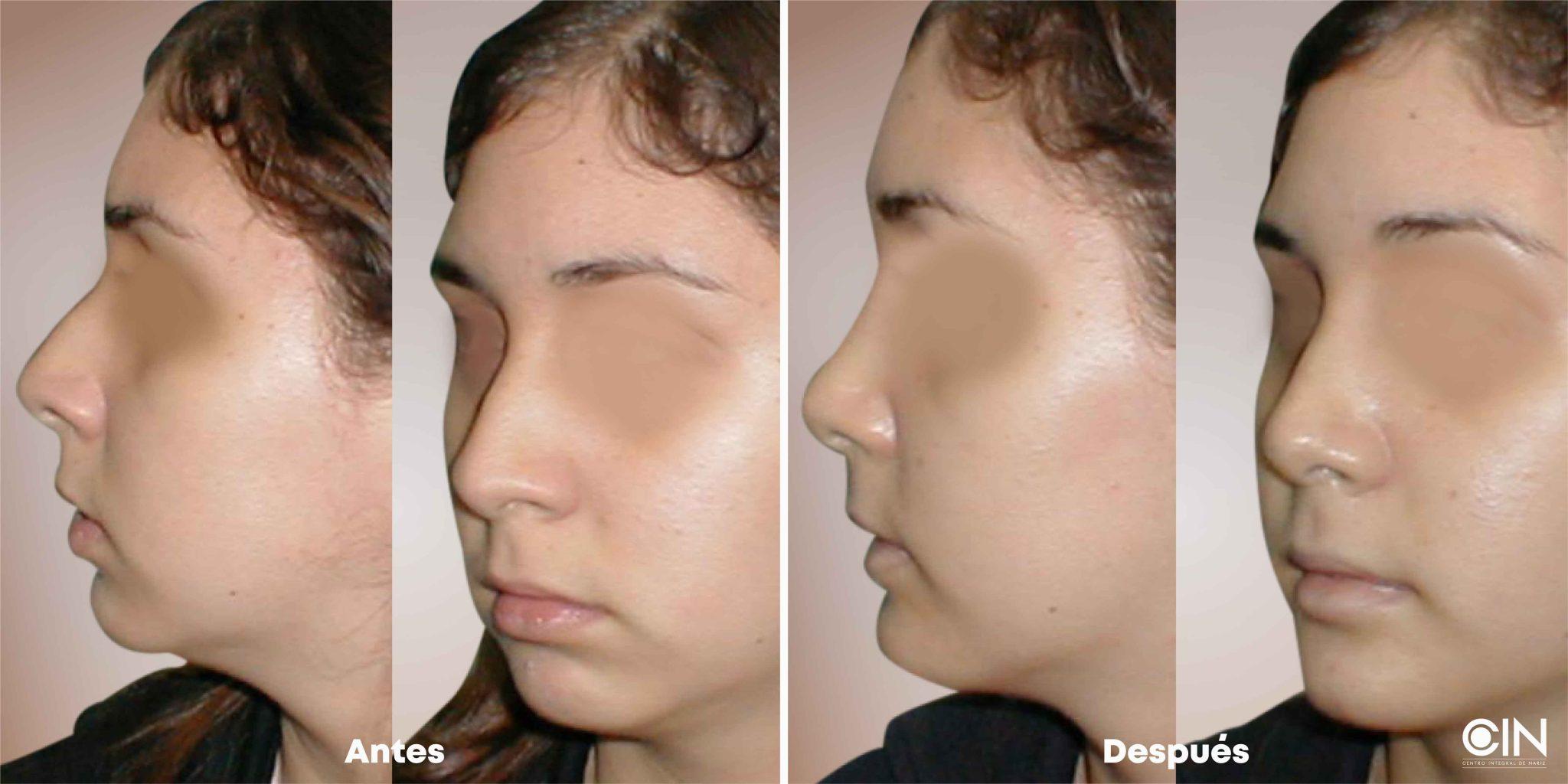Estudio de perfilometría – Centro Integral de Nariz